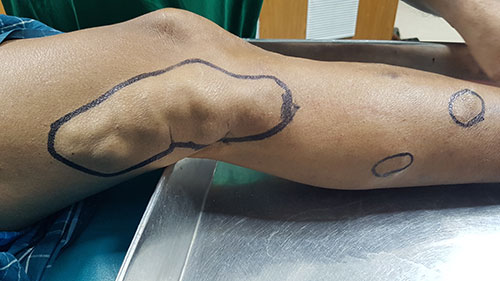 Varicose Vein Treatment - Dr Abul Hasan Muhammad Bashar